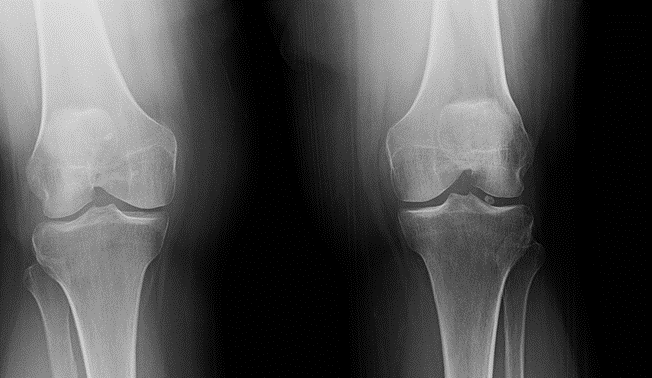 Loose Bodies/Spurs Knee Surgery - Rothman Orthopaedics