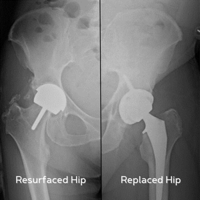Hip Replacement vs Hip Resurfacing - Rothman Orthopaedics