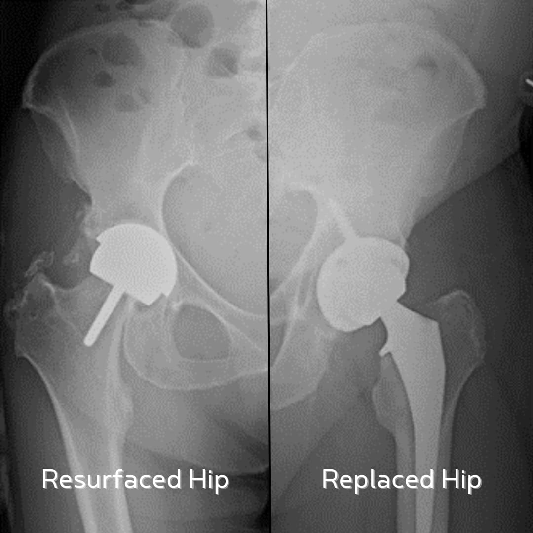 Hip Replacement vs Hip Resurfacing - Rothman Orthopaedics