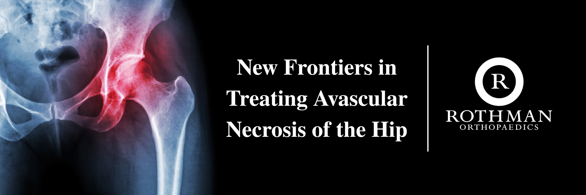 New Frontiers in Treating Avascular Necrosis of the Hip - Rothman ...